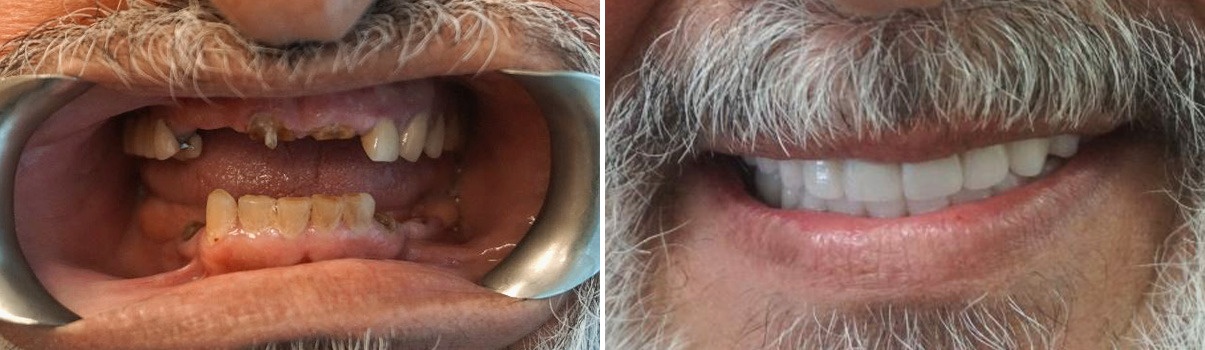 All-On-Four Photos - Uptown Cosmetic + Implant Dentistry